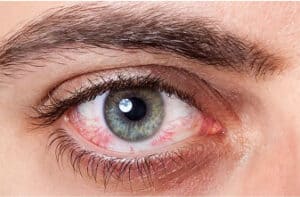 Limbal Relaxing Incisions (LRI) | Assil Gaur Eye LA