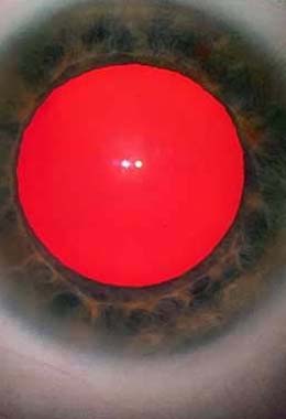 Cataract Before & After Pictures in Los Angeles | Assil Gaur Eye ...