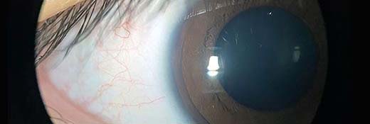 Conjunctival Nevus Removal Before and After Pictures in Los Angeles