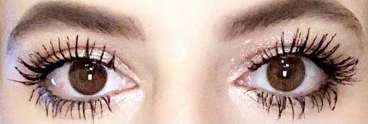 Conjunctival Nevus Removal Before and After Pictures in Los Angeles