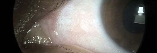 Conjunctival Nevus Removal Before and After Pictures in Los Angeles