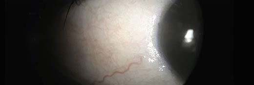 Conjunctival Nevus Removal Before and After Pictures in Los Angeles