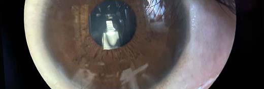 Conjunctival Nevus Removal Before and After Pictures in Los Angeles