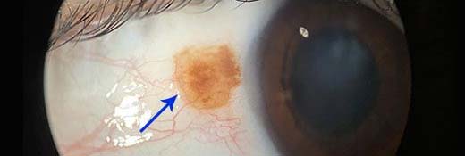 Conjunctival Nevus Removal Before and After Pictures in Los Angeles