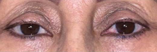 Eyelid Ptosis Before & After Pictures in Los Angeles