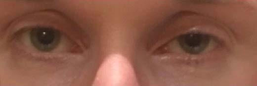Eyelid Ptosis Before & After Pictures in Los Angeles
