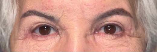 Eyelid Ptosis Before & After Pictures in Los Angeles