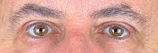 Eyelid Ptosis Before & After Pictures in Los Angeles